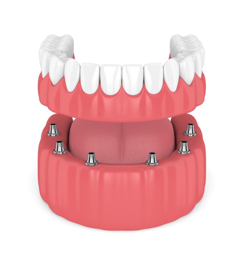 Complete Your Smile with Done In One in Columbia Today